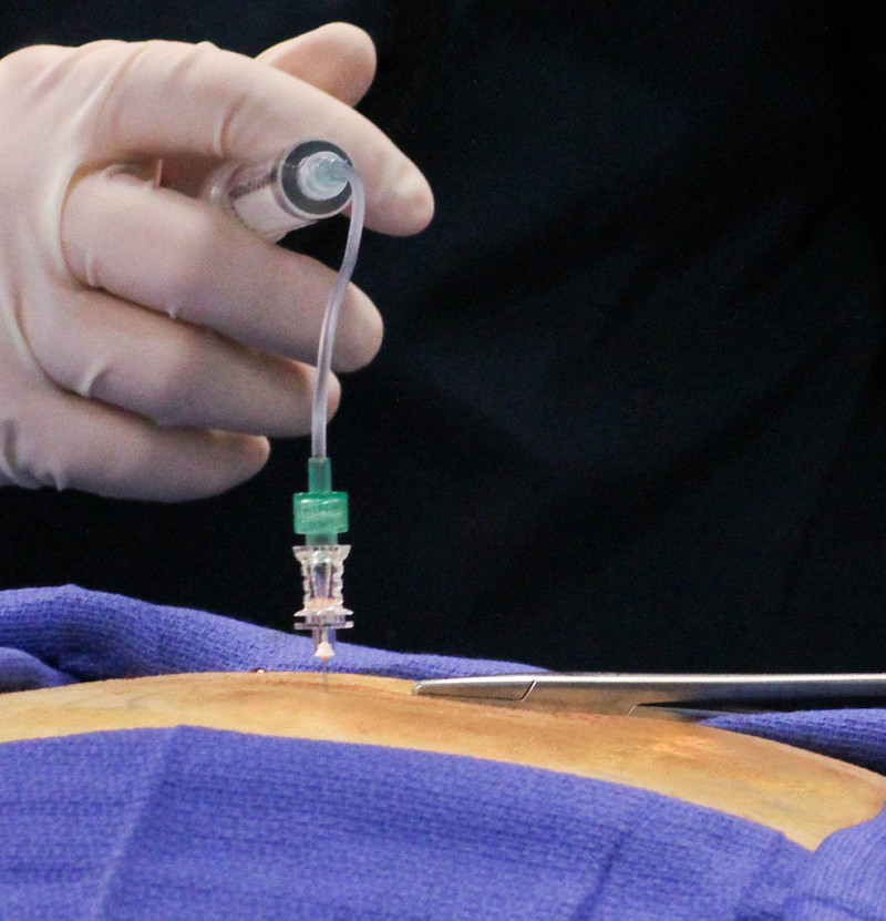 Medial Branch Blocks (MBB) | Diagnostic Blocks for Pain